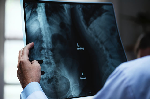 How Herniated Disc Injections Relieve Back Pain – NY Orthopedics